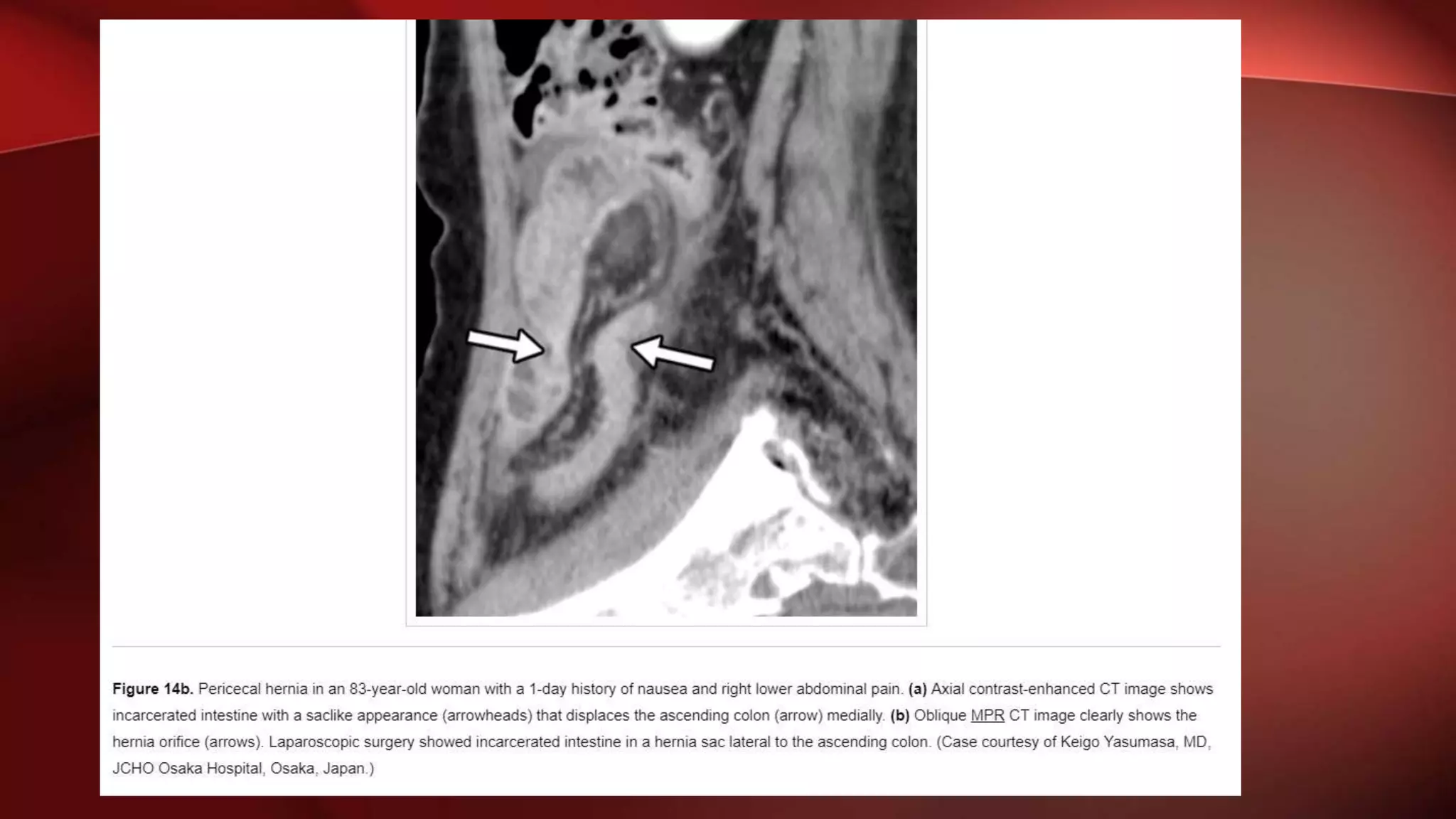 CT of Internal Hernia | PPTX
