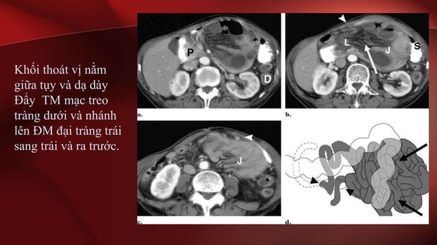 CT of Internal Hernia | PPT
