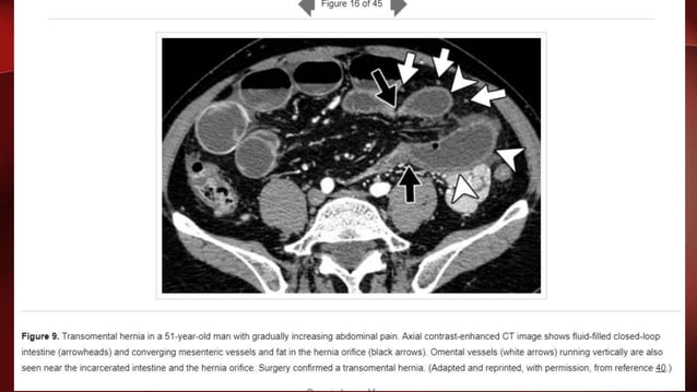 CT of Internal Hernia | PPT