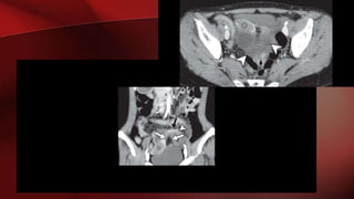 CT of Internal Hernia | PPTX