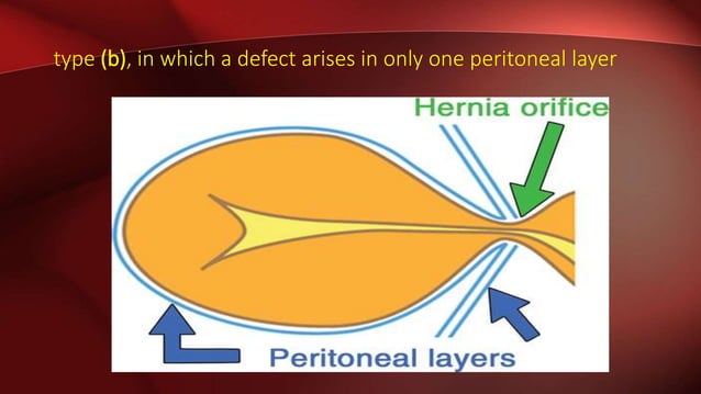 CT of Internal Hernia | PPT