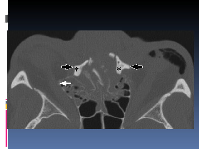 Ct of maxillofacial trauma | PPT