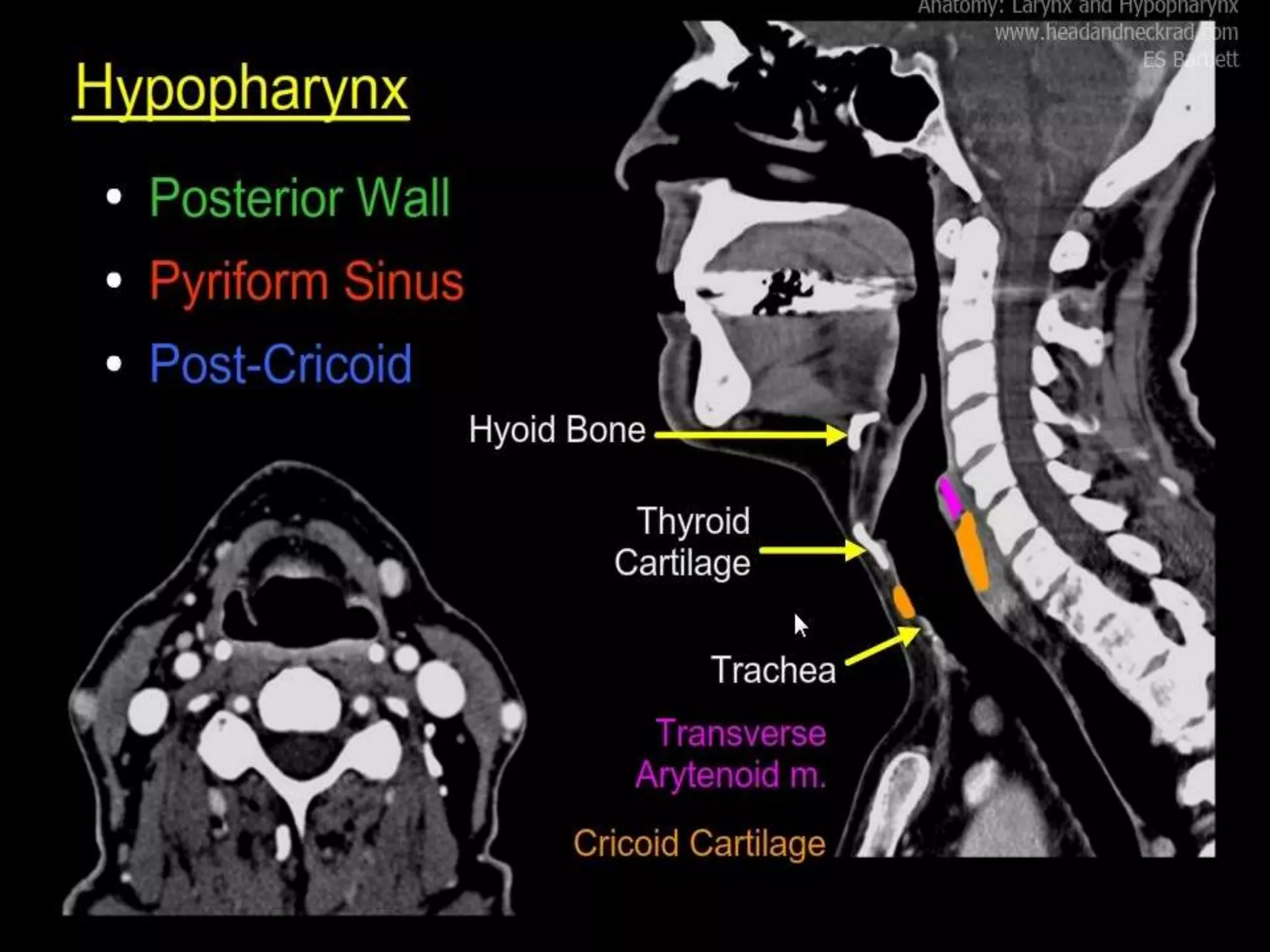 Ct of the larynx | PPTX