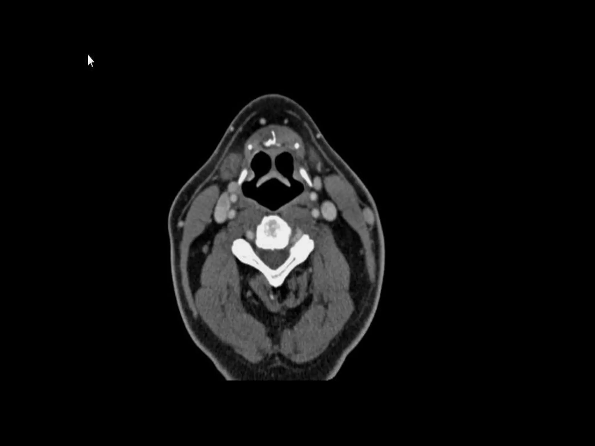 Ct of the larynx | PPTX