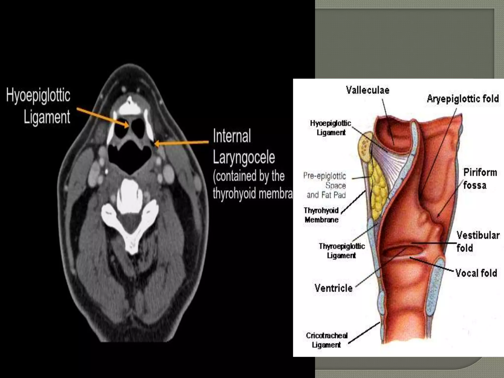 Ct of the larynx | PPTX
