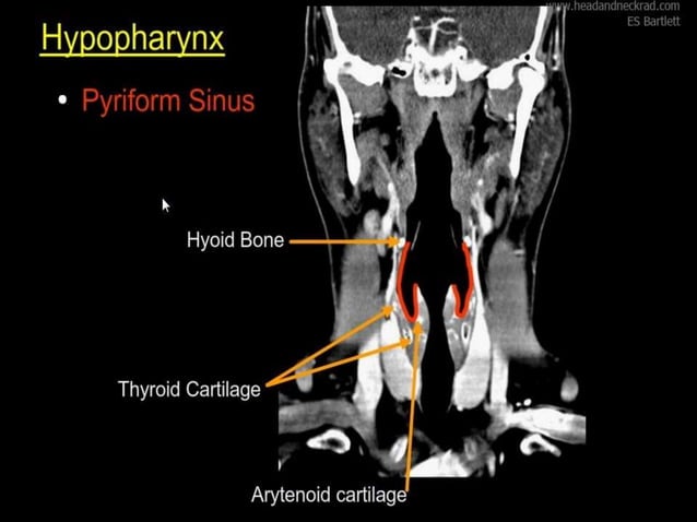 Ct of the larynx | PPTX | Ear, Nose and Throat Conditions | Diseases ...