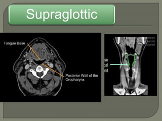 Ct of the larynx | PPTX