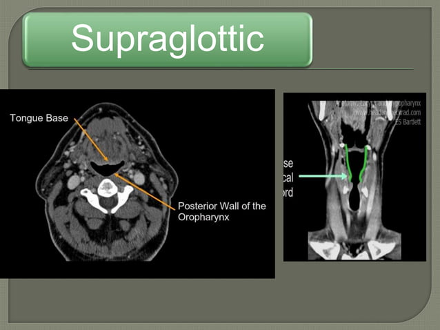 Ct of the larynx | PPTX | Ear, Nose and Throat Conditions | Diseases ...