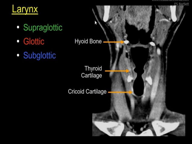 Ct of the larynx | PPTX | Ear, Nose and Throat Conditions | Diseases ...