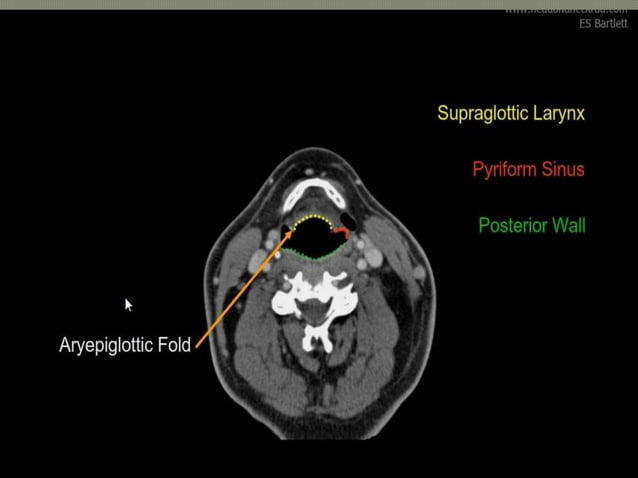 Ct of the larynx | PPTX | Ear, Nose and Throat Conditions | Diseases ...