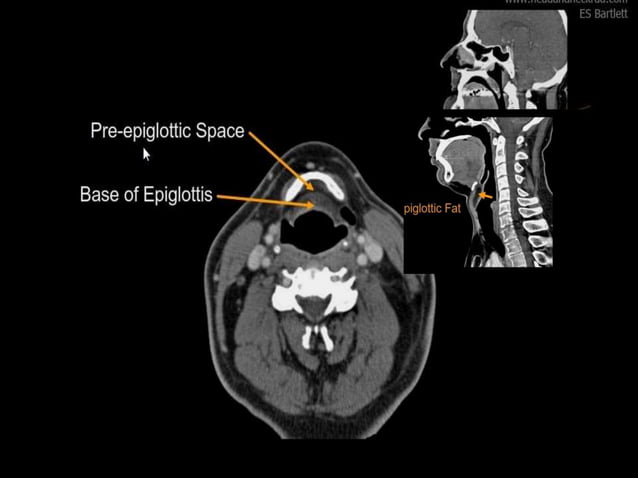 Ct of the larynx | PPTX | Ear, Nose and Throat Conditions | Diseases ...