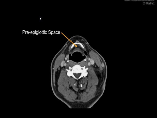 Ct of the larynx | PPTX | Ear, Nose and Throat Conditions | Diseases ...