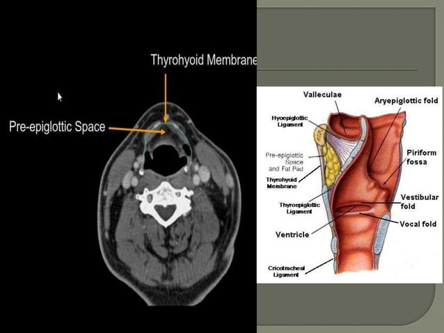 Ct of the larynx | PPTX | Ear, Nose and Throat Conditions | Diseases ...