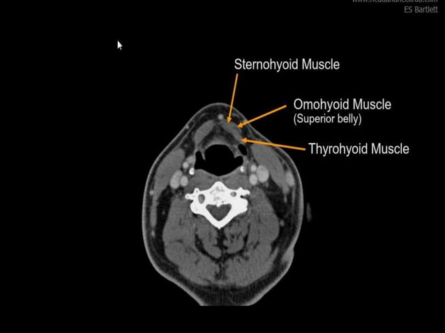 Ct of the larynx | PPTX | Ear, Nose and Throat Conditions | Diseases ...