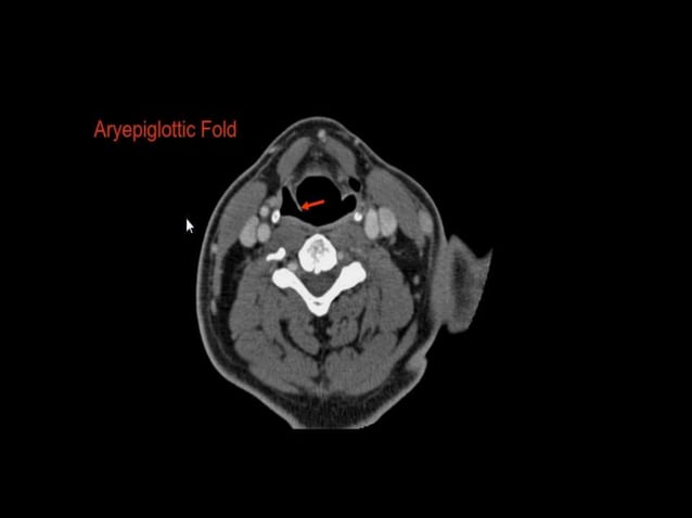 Ct of the larynx | PPTX | Ear, Nose and Throat Conditions | Diseases ...