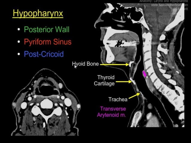 Ct of the larynx | PPT