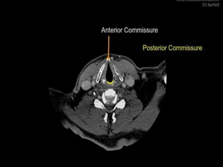 Posterior Commissure Larynx