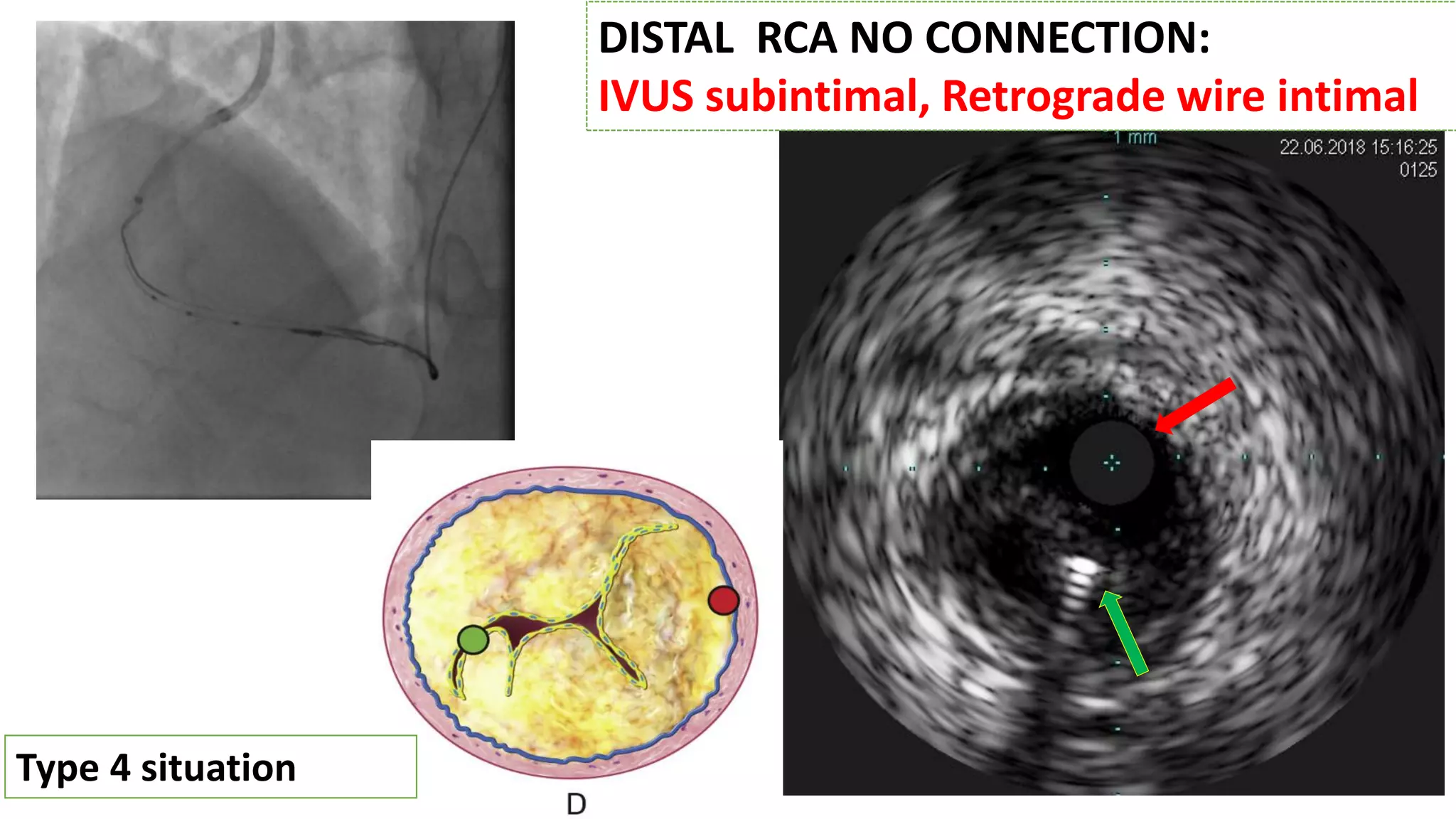Intracoronary Imaging – When to use, how to use and how to interpret ...