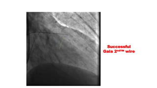 Intracoronary Imaging – When to use, how to use and how to interpret ...