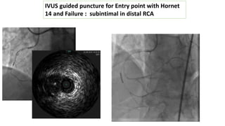 Intracoronary Imaging – When to use, how to use and how to interpret ...