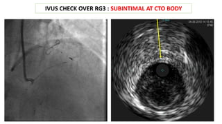 Intracoronary Imaging – When to use, how to use and how to interpret ...
