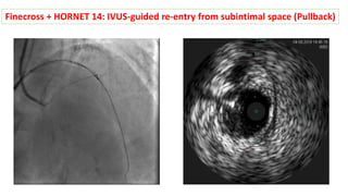 Intracoronary Imaging – When to use, how to use and how to interpret ...