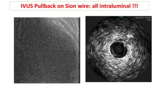 Intracoronary Imaging – When to use, how to use and how to interpret ...
