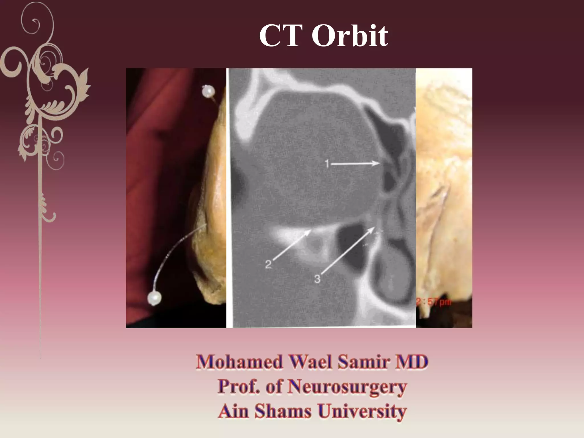 Ct orbit | PPTX