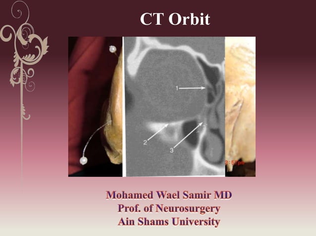 Ct orbit | PPTX | Eye and Vision Conditions | Diseases and Conditions