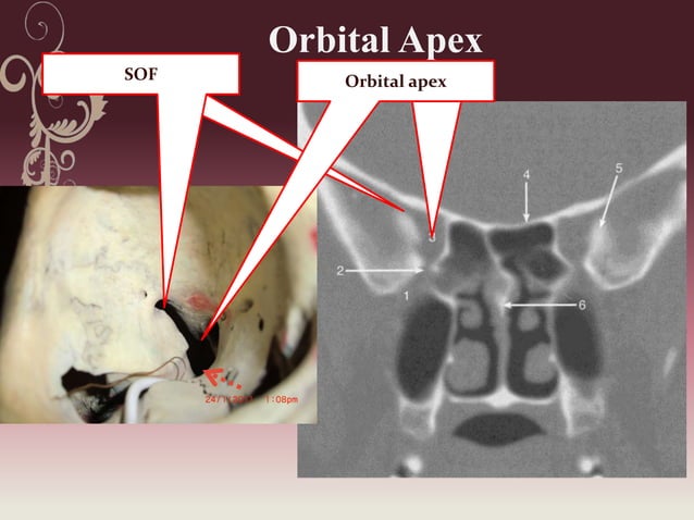 Ct orbit | PPTX | Eye and Vision Conditions | Diseases and Conditions