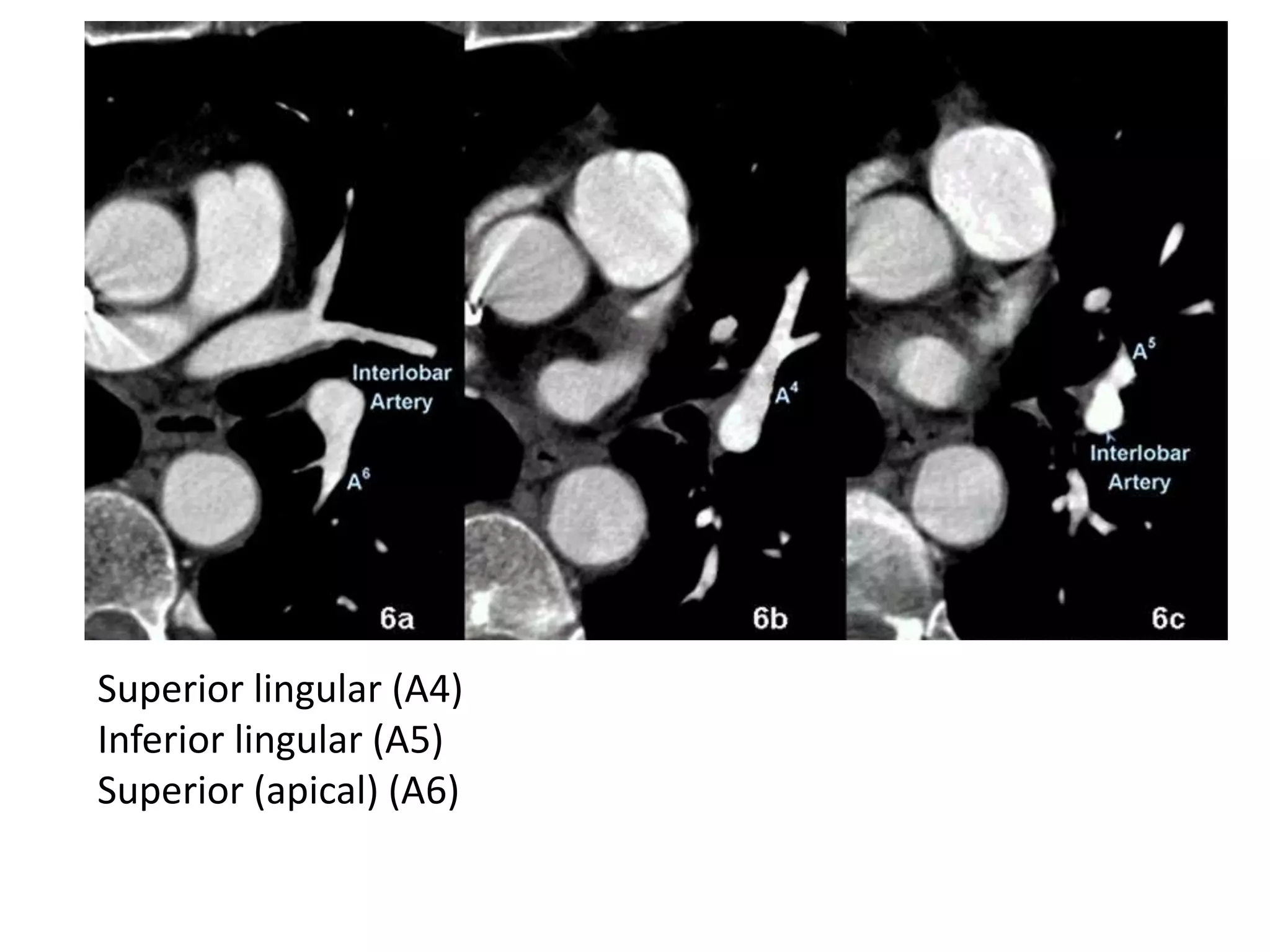 CT Pulmonary Angiography | PPTX