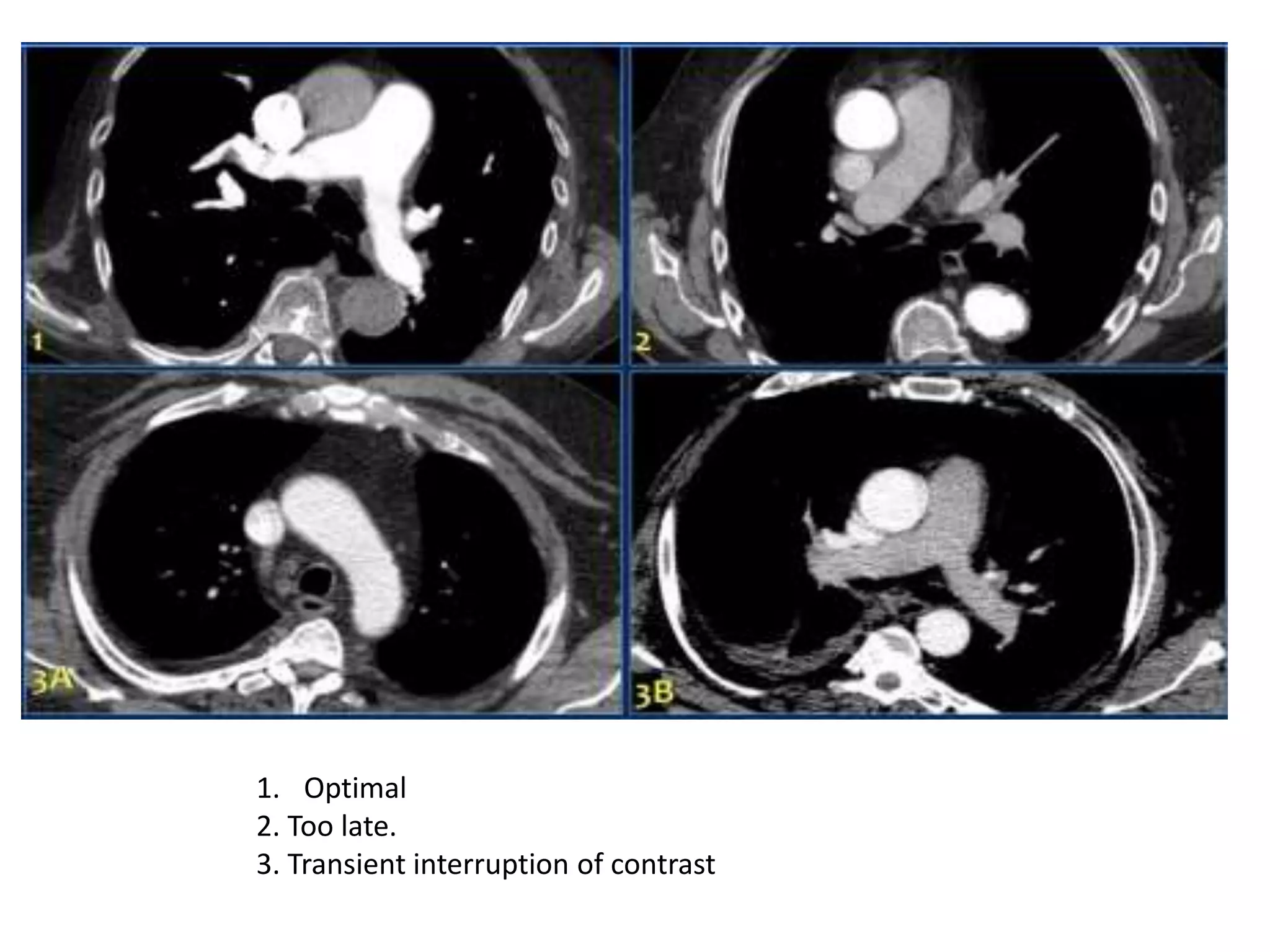 CT Pulmonary Angiography | PPTX