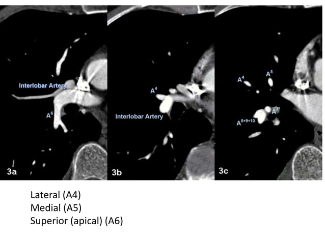 CT Pulmonary Angiography | PPTX