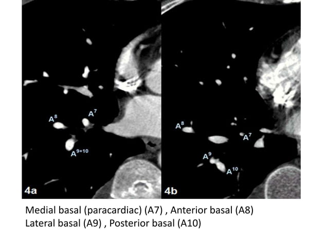 CT Pulmonary Angiography | PPTX