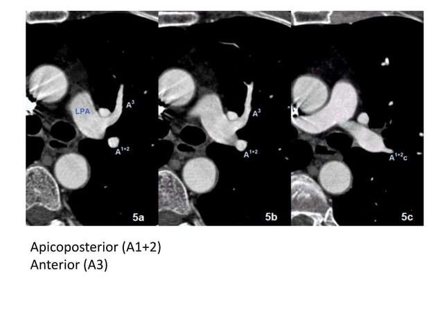 CT Pulmonary Angiography | PPTX