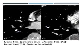 CT PA | PPTX | Lung and Respiratory Health | Diseases and Conditions