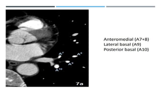 CT PA | PPTX | Lung and Respiratory Health | Diseases and Conditions