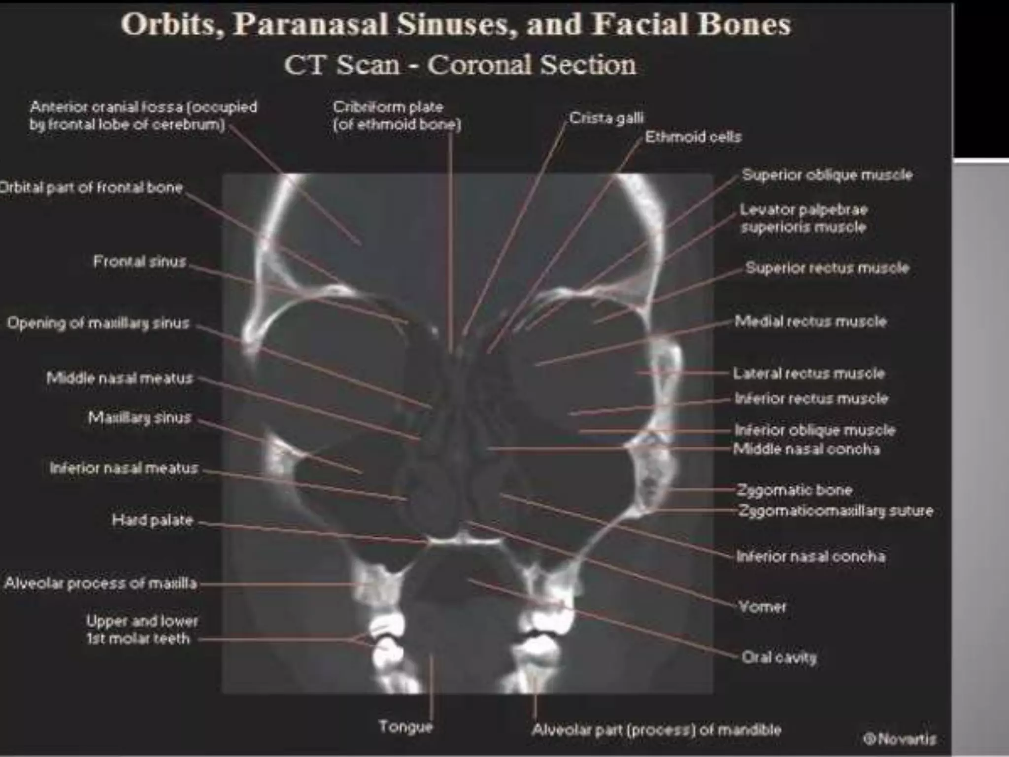 Ct anatomy of paranasal sinus | PPTX