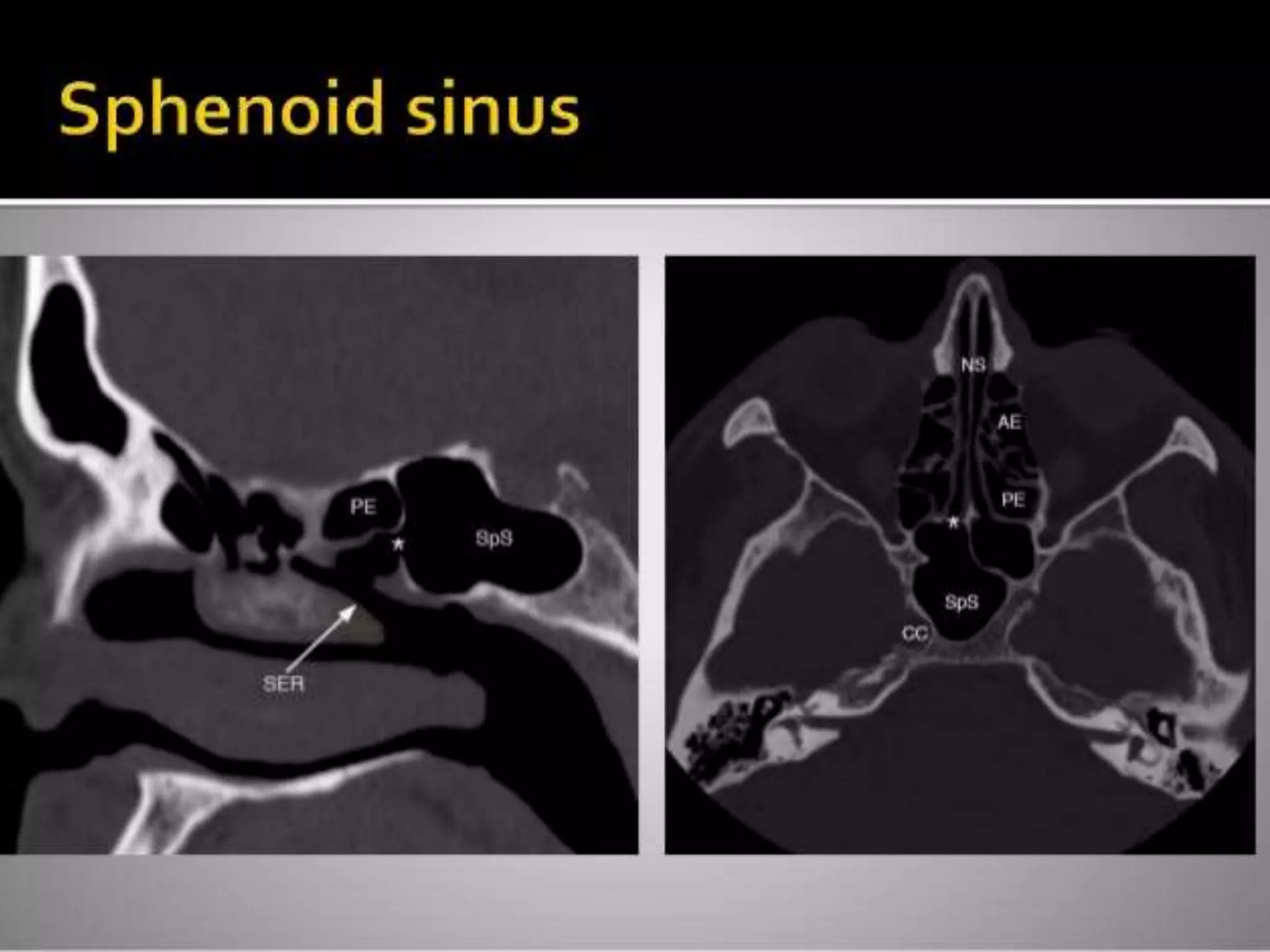 Ct anatomy of paranasal sinus | PPTX