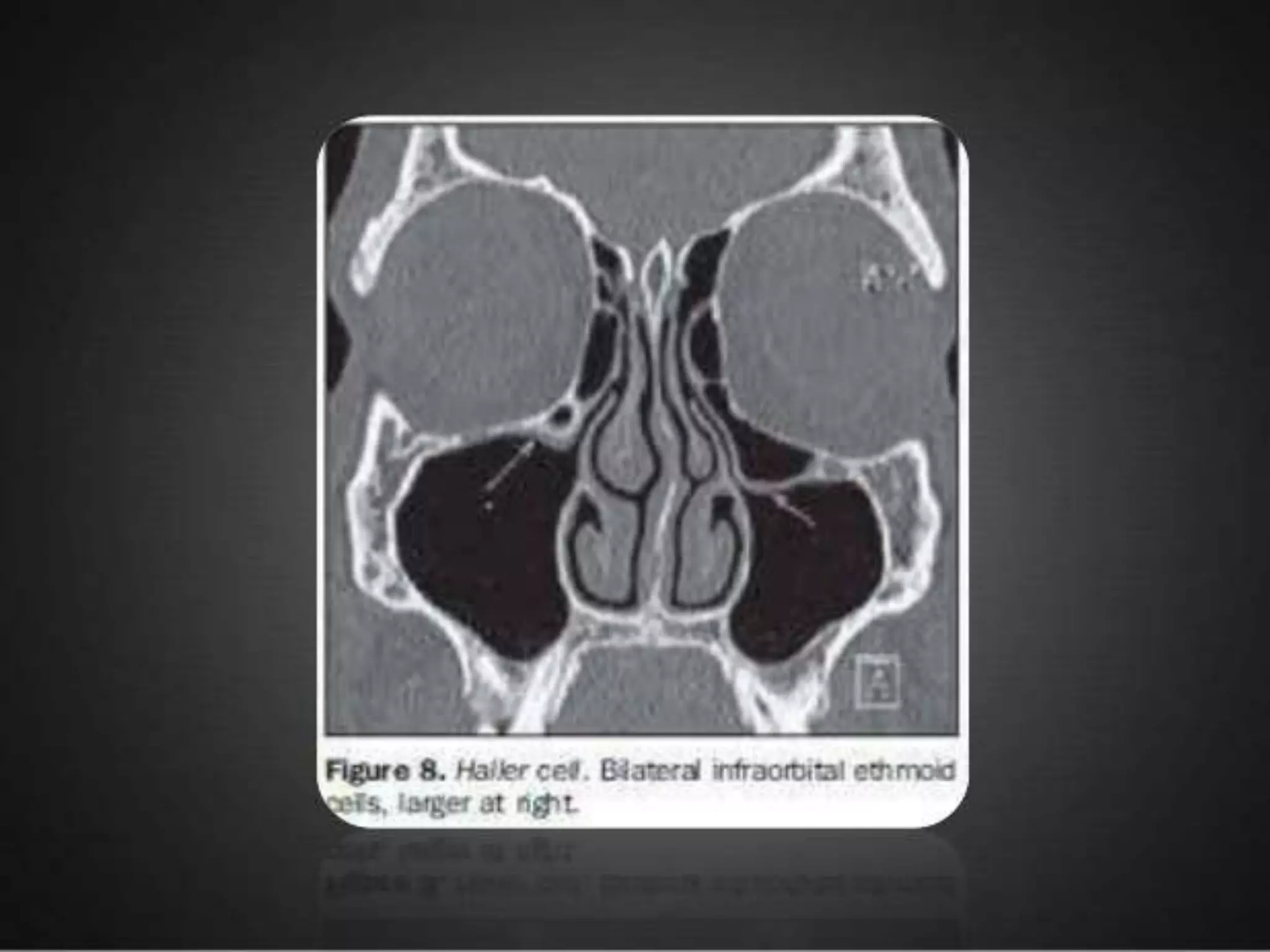 Ct anatomy of paranasal sinus | PPTX