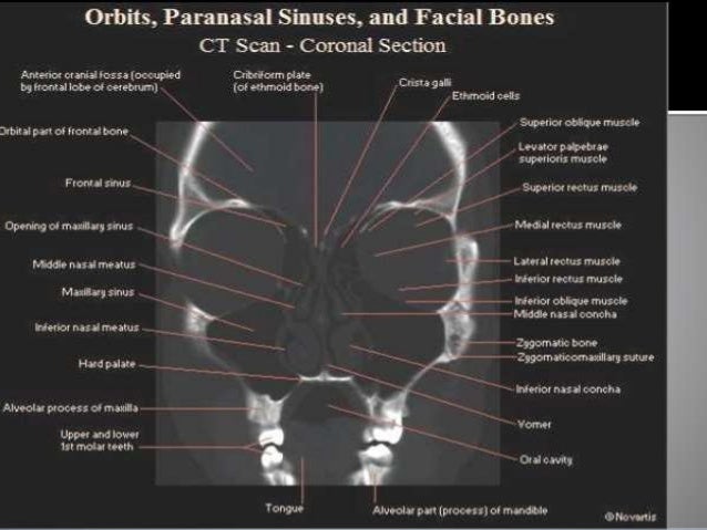 Ct anatomy of paranasal sinus