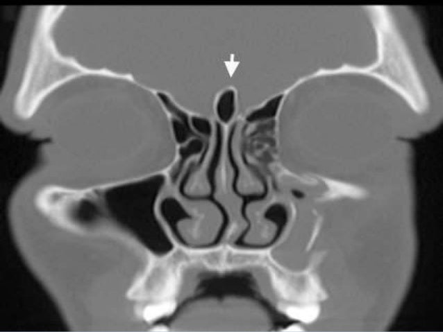 Sinus Ct Anatomy
