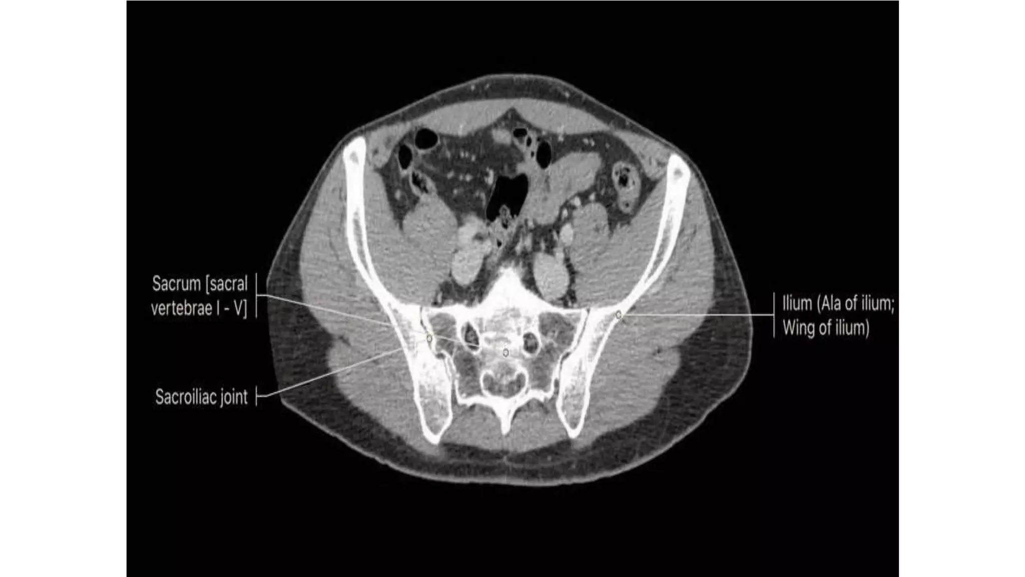 Ct pelvis and its pathologies | PPTX