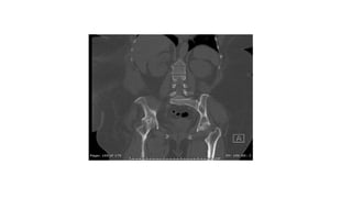 Ct pelvis and its pathologies | PPTX
