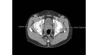 Ct pelvis and its pathologies | PPTX