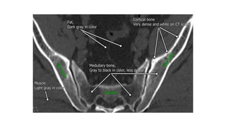 Ct pelvis and its pathologies | PPTX