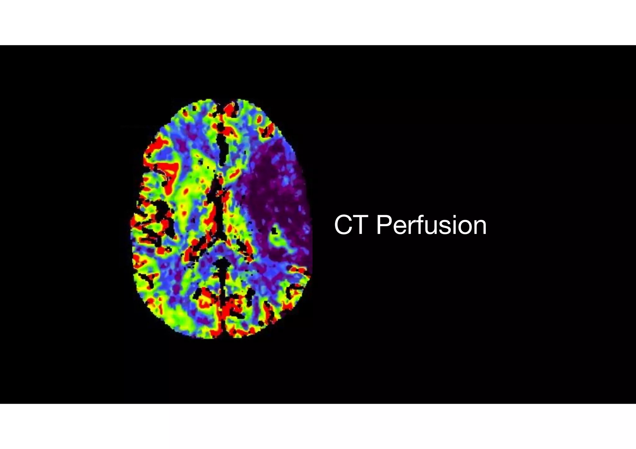 Neuro EM: Neuroimaging Nibble CTP mismatch in Acute Ischemic Stroke | PPT