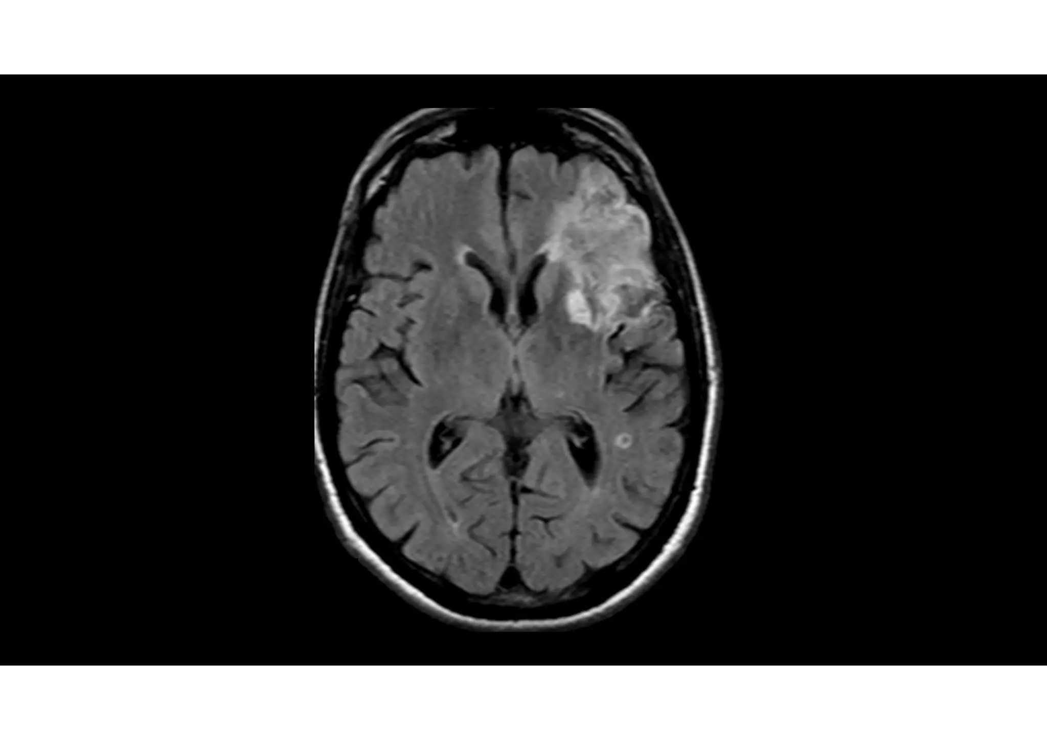 Neuro EM: Neuroimaging Nibble CTP mismatch in Acute Ischemic Stroke | PPT