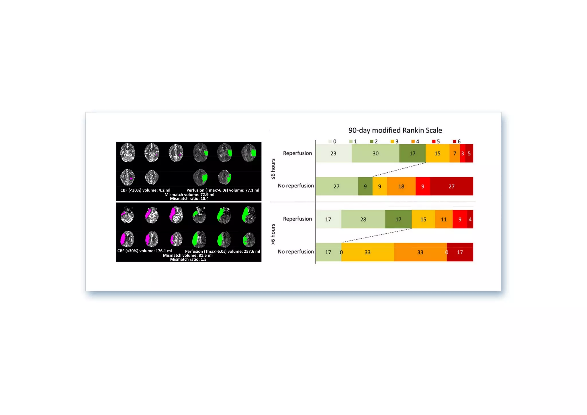 Neuro EM: Neuroimaging Nibble CTP mismatch in Acute Ischemic Stroke | PDF