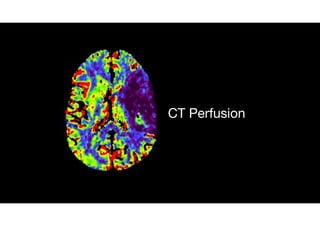 Neuro EM: Neuroimaging Nibble CTP mismatch in Acute Ischemic Stroke | PPT
